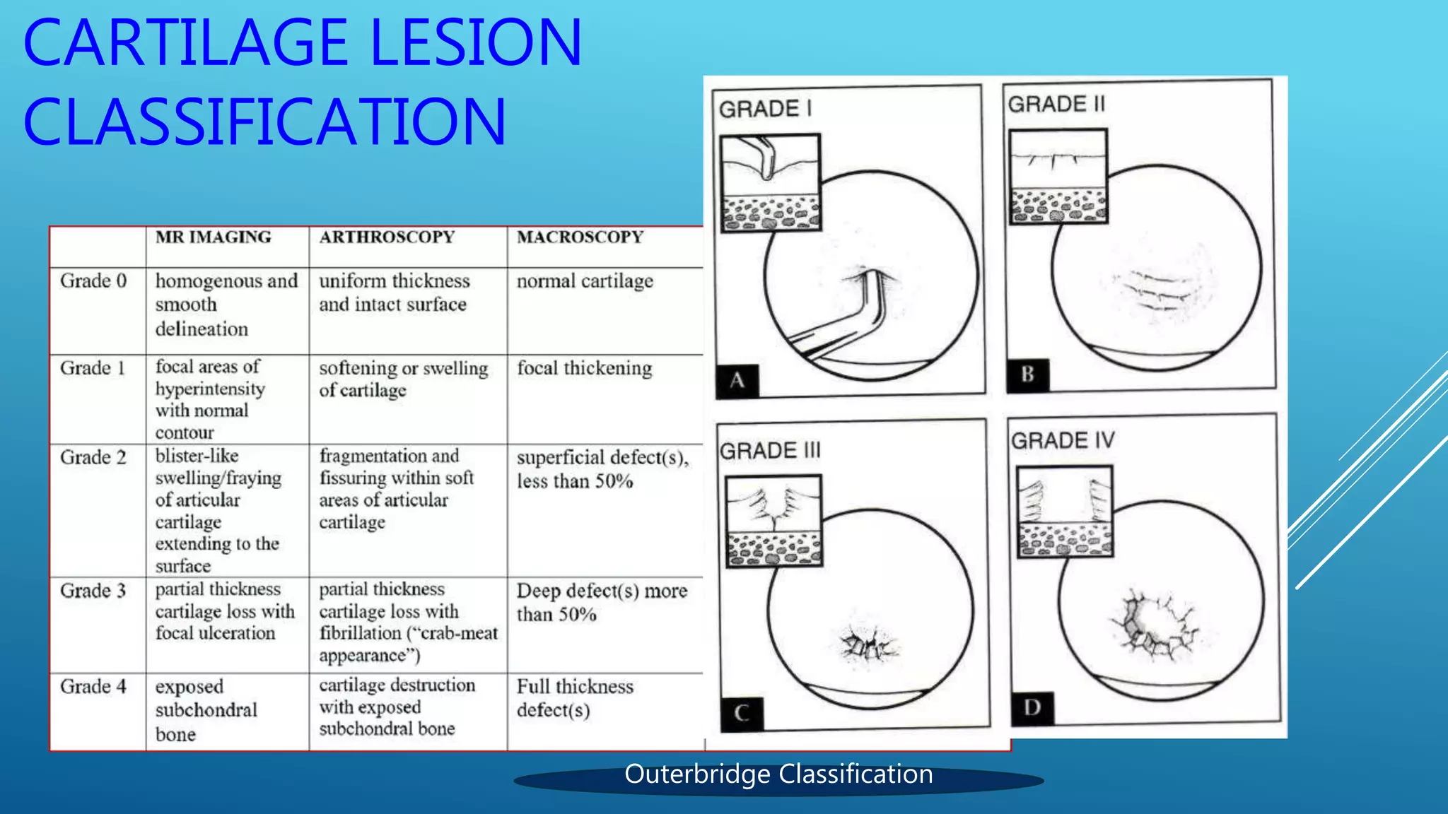 Management of knee cartilage defect & meniscus tear | PPTX
