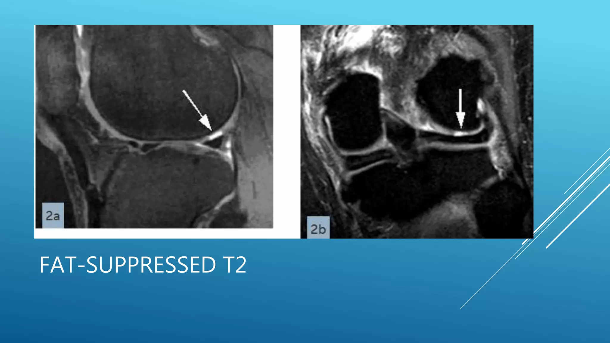 Management of knee cartilage defect & meniscus tear | PPTX