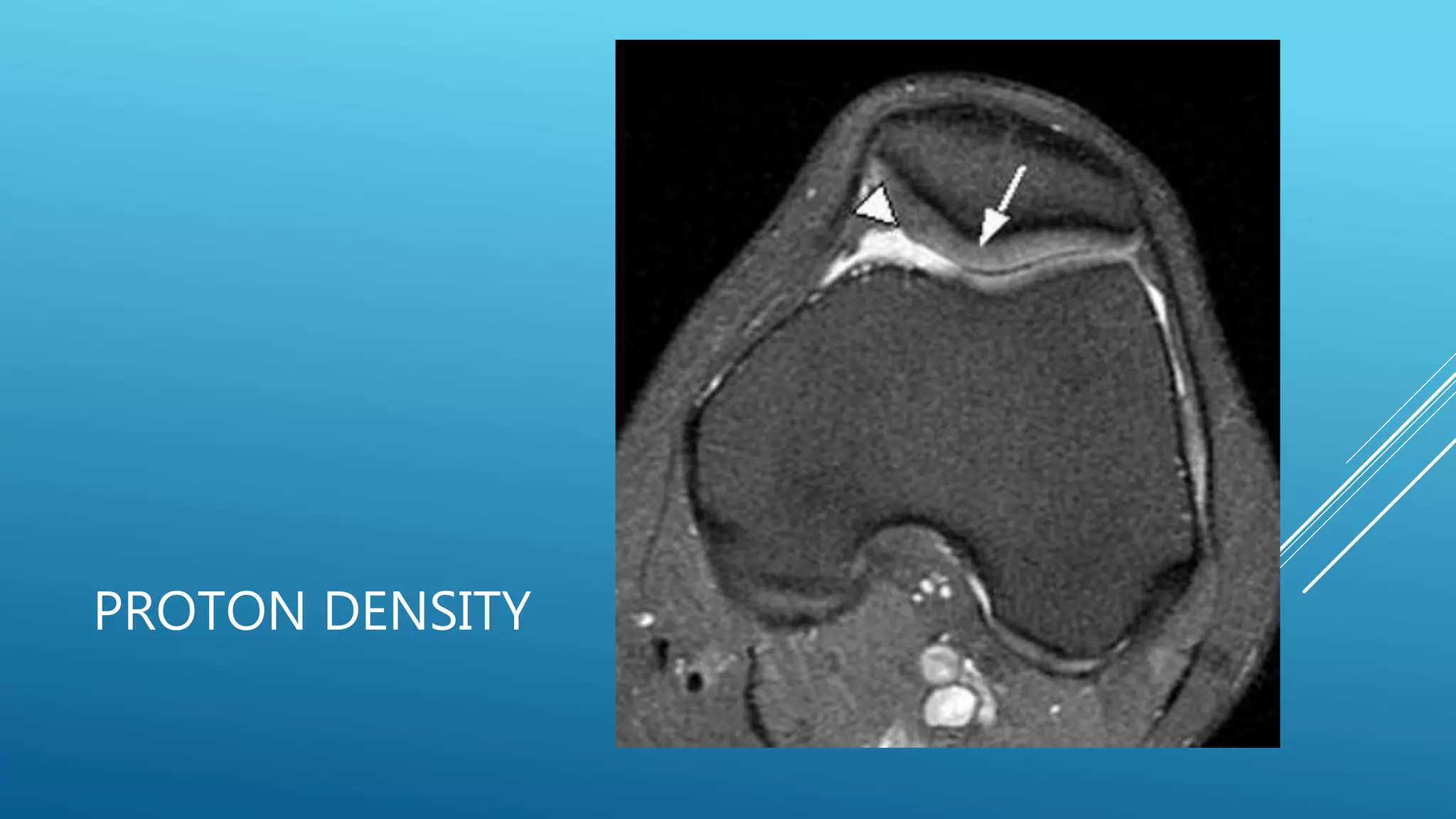 Management of knee cartilage defect & meniscus tear | PPTX
