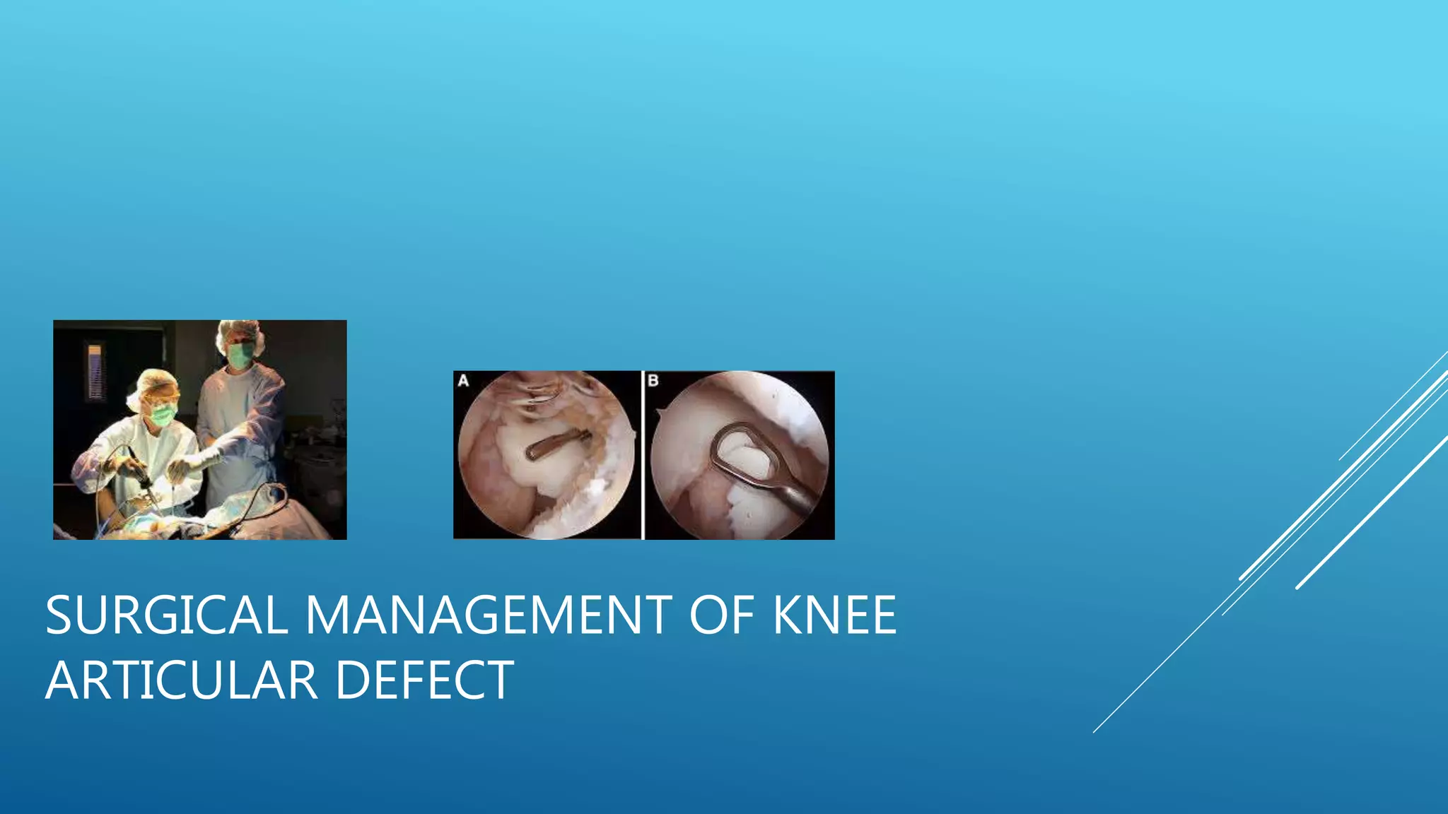 Management of knee cartilage defect & meniscus tear | PPTX