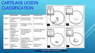 Management of knee cartilage defect & meniscus tear | PPTX