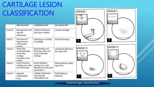 Management of knee cartilage defect & meniscus tear | PPTX