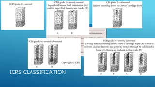 Management of knee cartilage defect & meniscus tear | PPTX