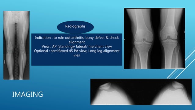 Management of knee cartilage defect & meniscus tear | PPTX