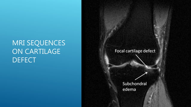 Management of knee cartilage defect & meniscus tear | PPTX