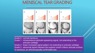 Management of knee cartilage defect & meniscus tear | PPTX