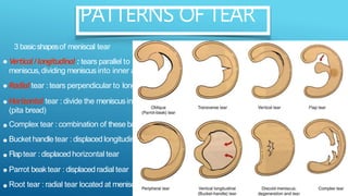 Management of knee cartilage defect & meniscus tear | PPTX