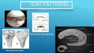 Management of knee cartilage defect & meniscus tear | PPTX