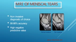 Management of knee cartilage defect & meniscus tear | PPTX
