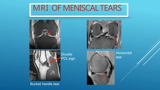 Management of knee cartilage defect & meniscus tear | PPTX