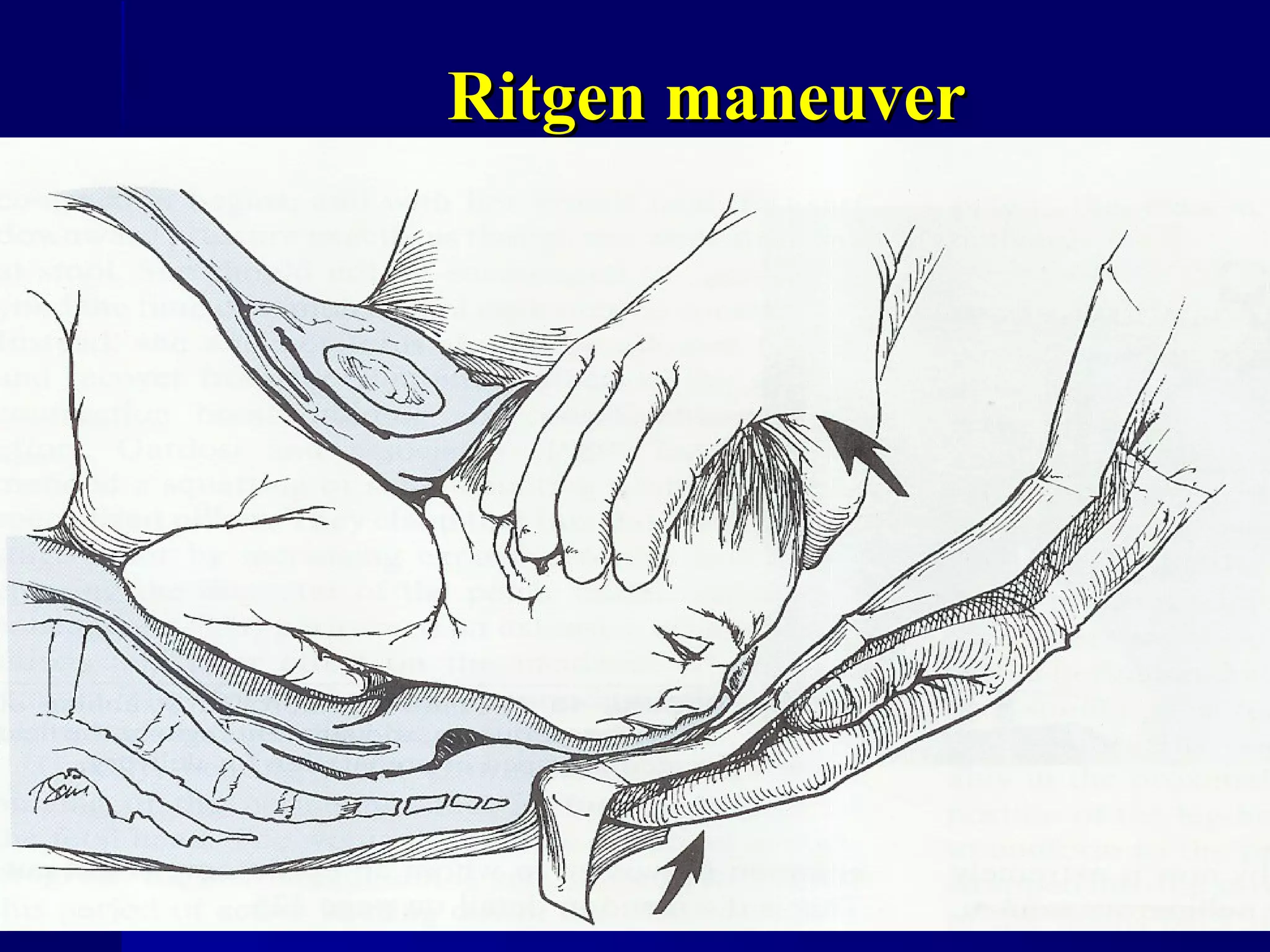 Management of Labor- 1st ,2nd and 3rd stages | PPT