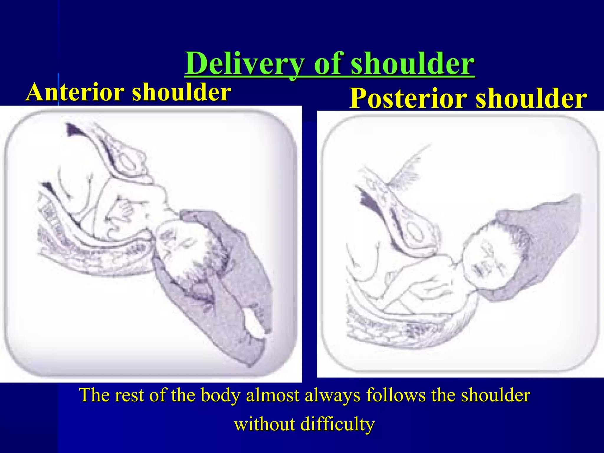 Management of Labor- 1st ,2nd and 3rd stages | PPT