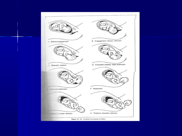 Management of Labor- 1st ,2nd and 3rd stages | PPT | Pregnancy ...