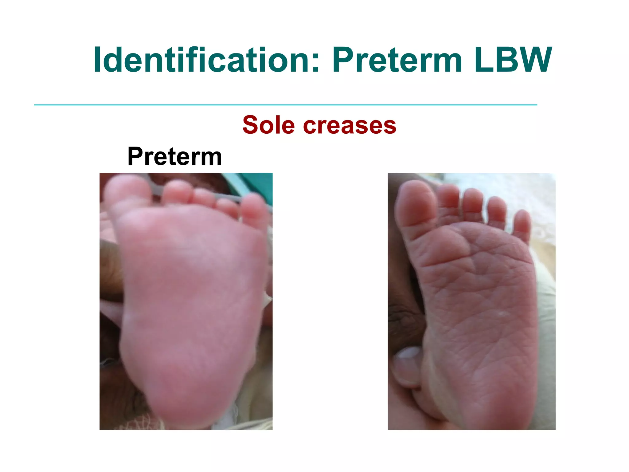 Management of lbw low birthweight babies | PPT
