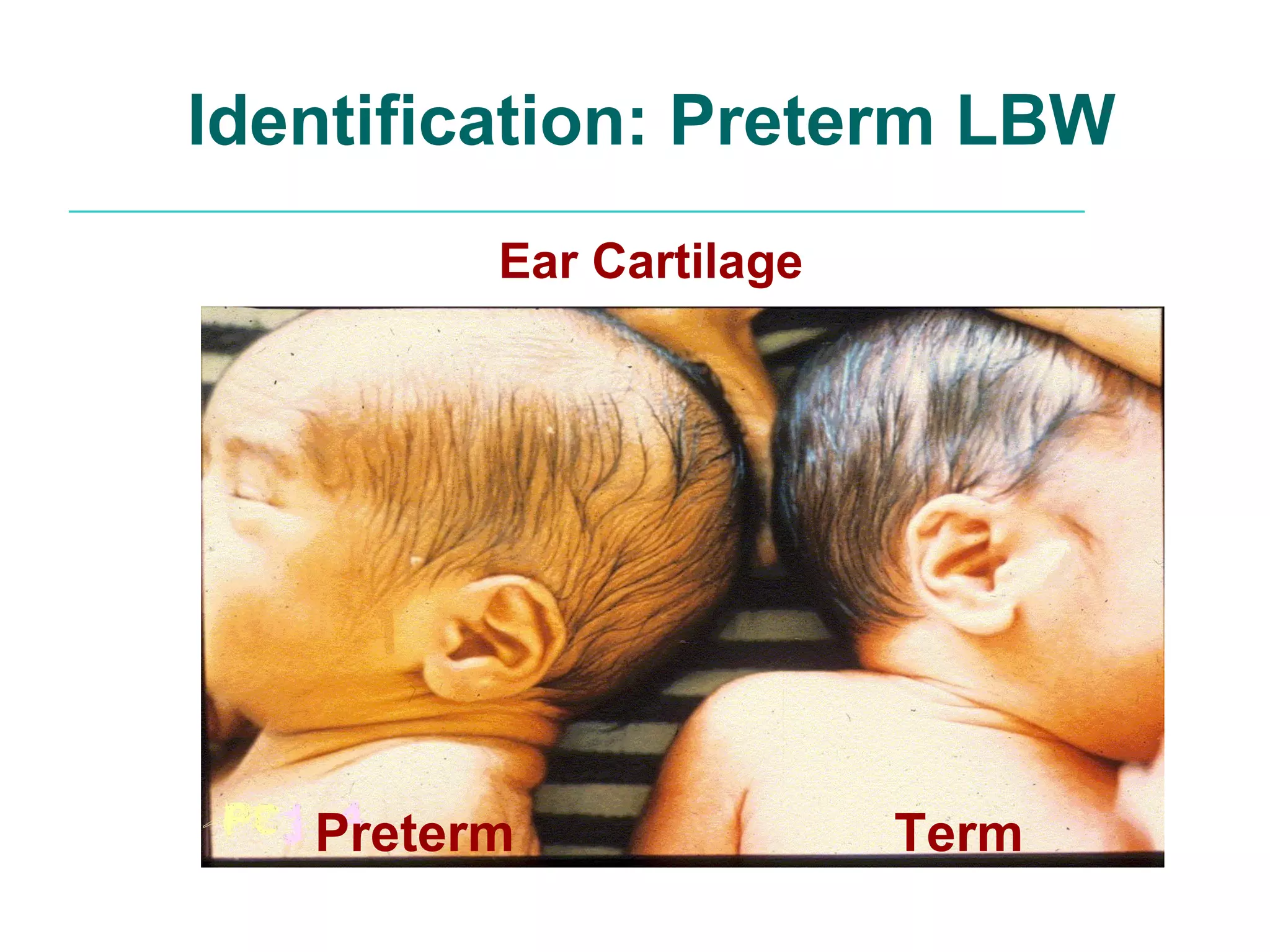 Management of lbw low birthweight babies | PPT
