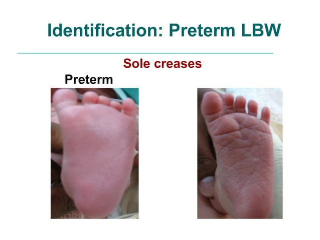 Management of lbw low birthweight babies | PPT