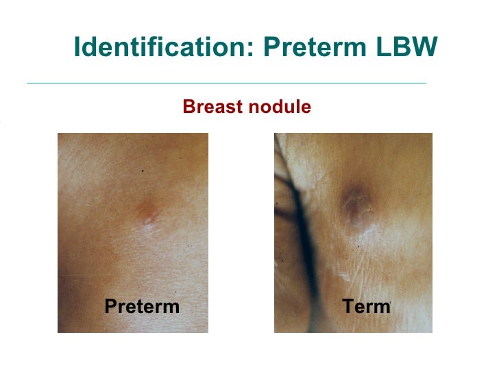 Management of lbw low birthweight babies
