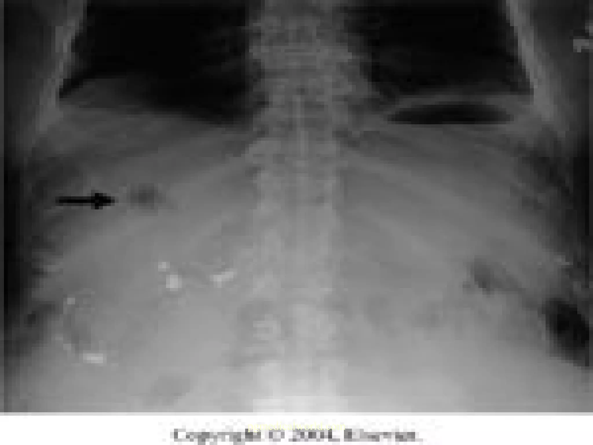 Management of liver abscess | PPT