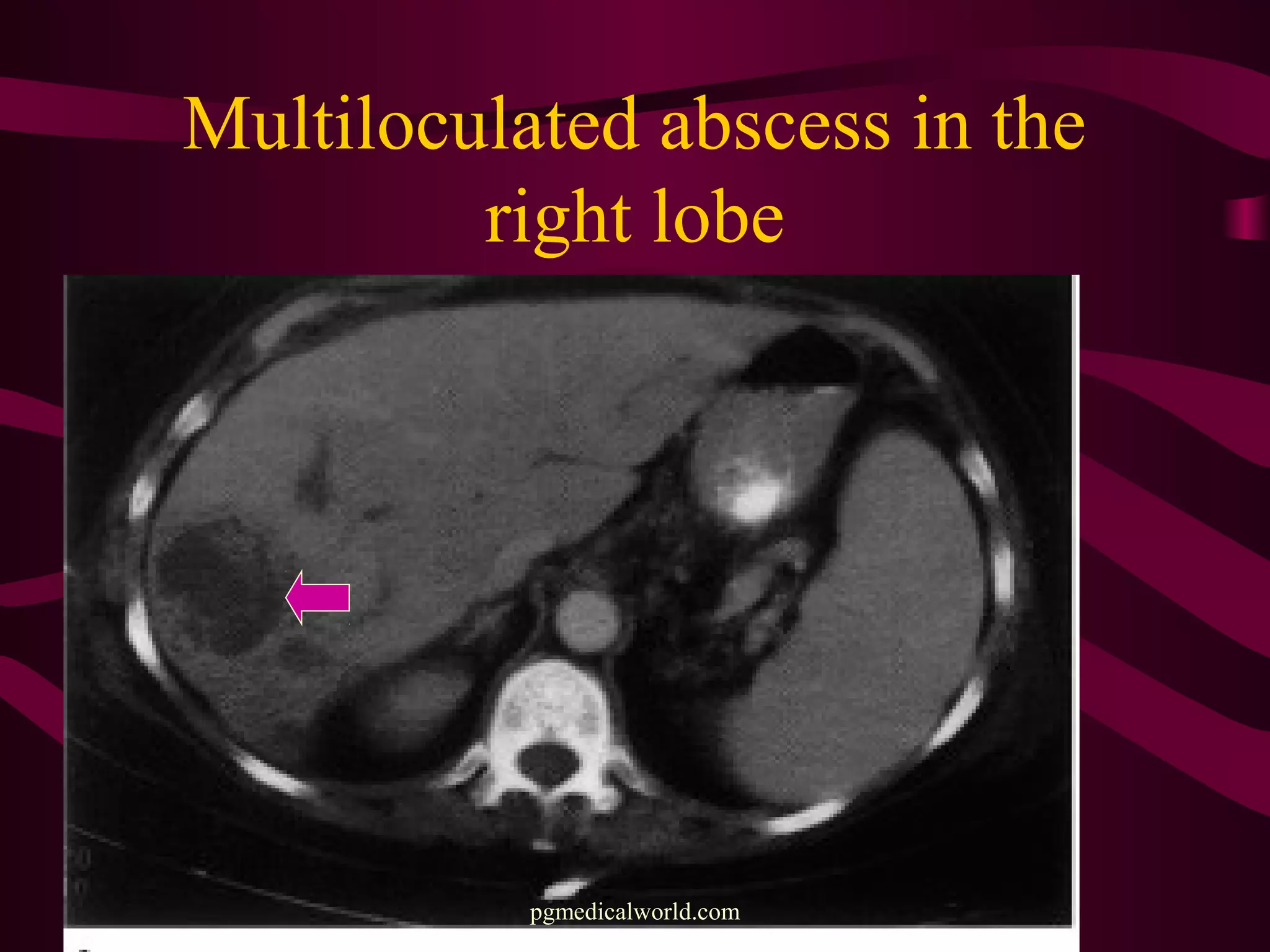 Management of liver abscess | PPT