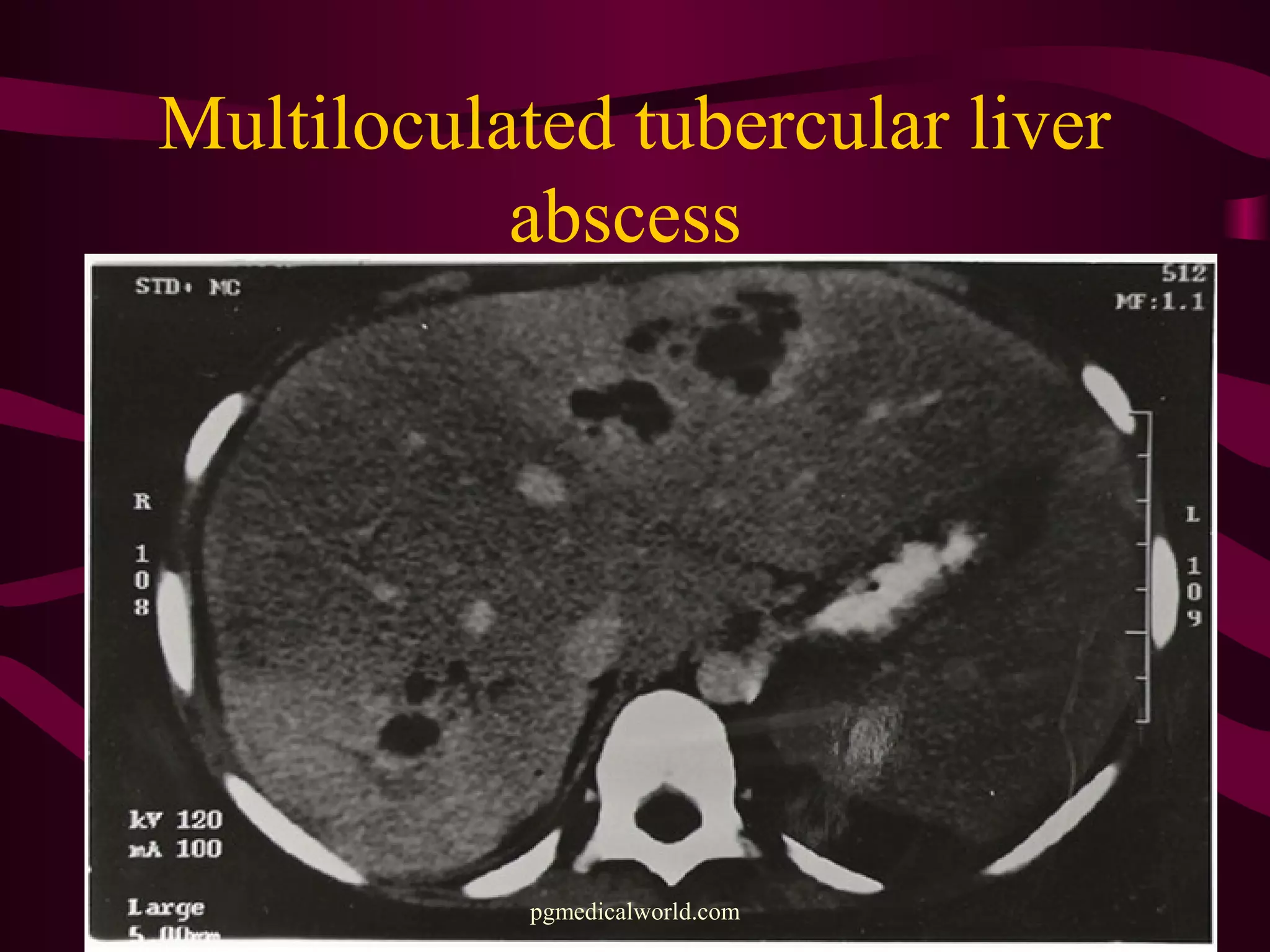 Management of liver abscess | PPT