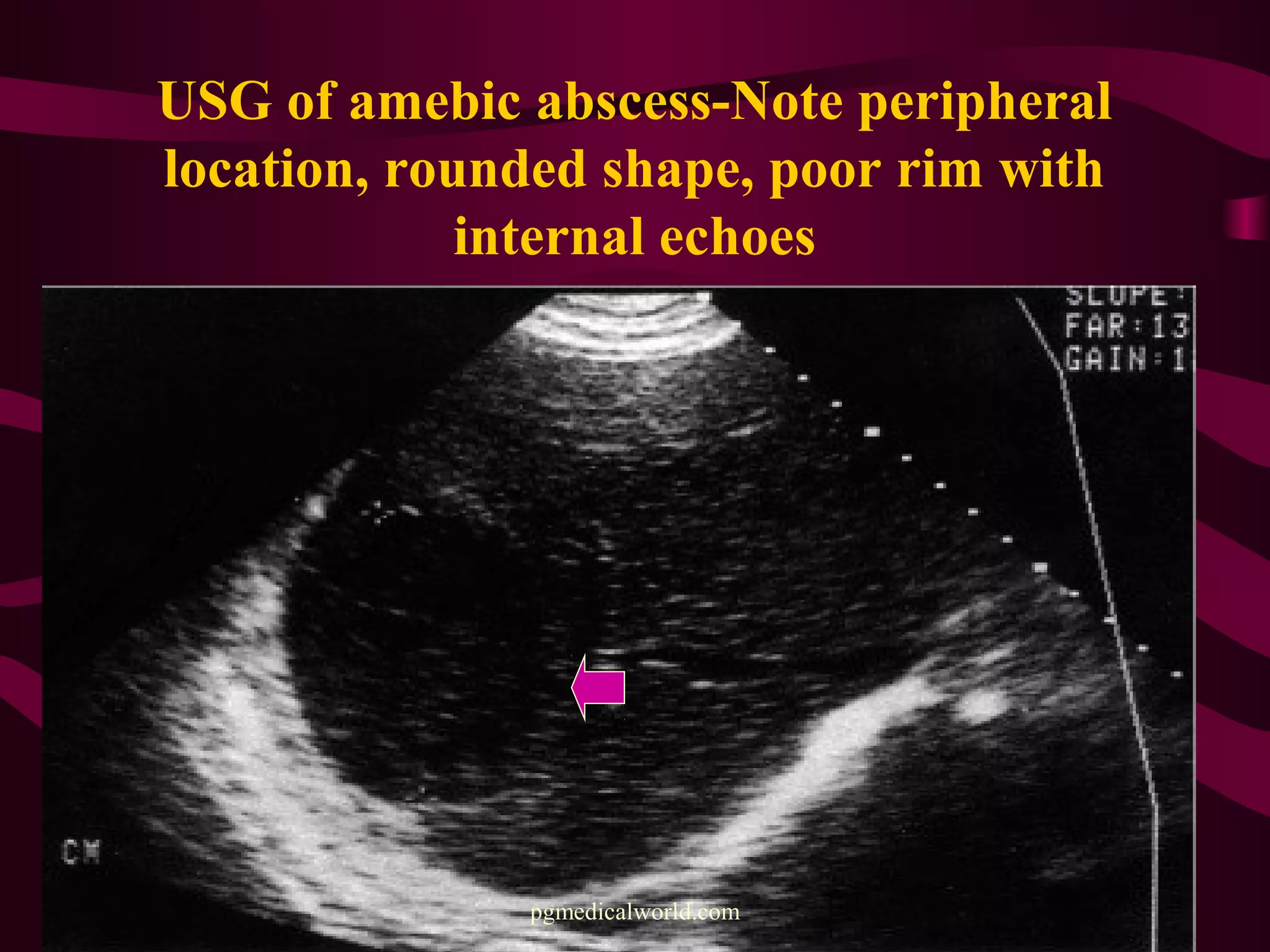 Management of liver abscess | PPT