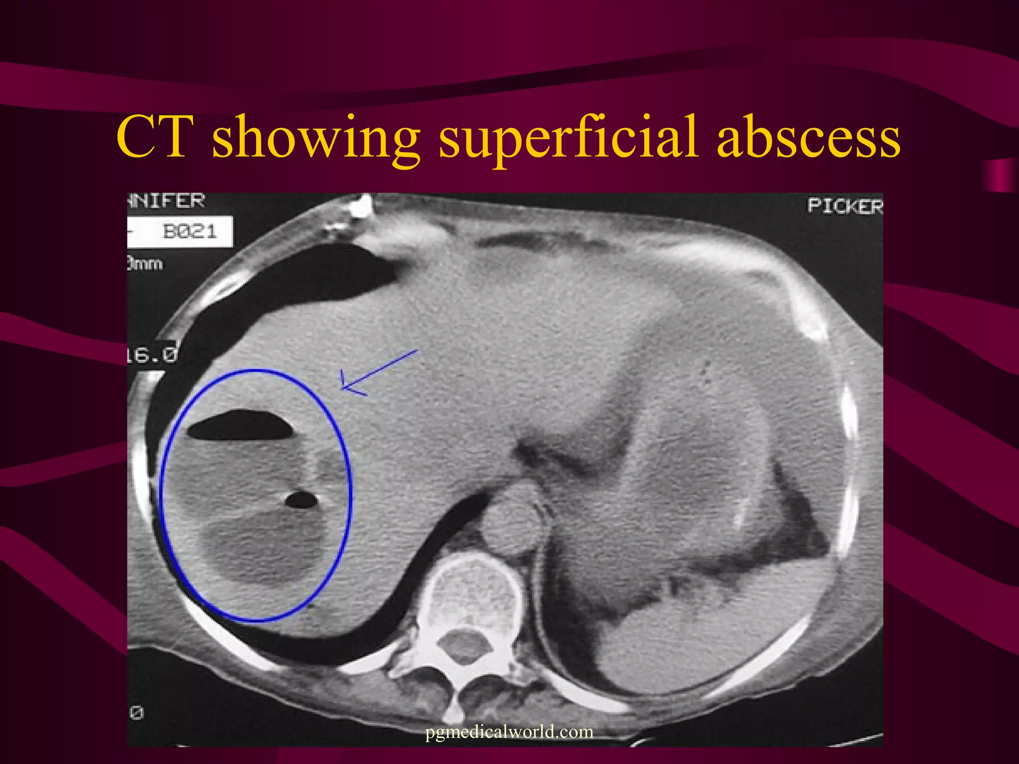 Management of liver abscess | PPT