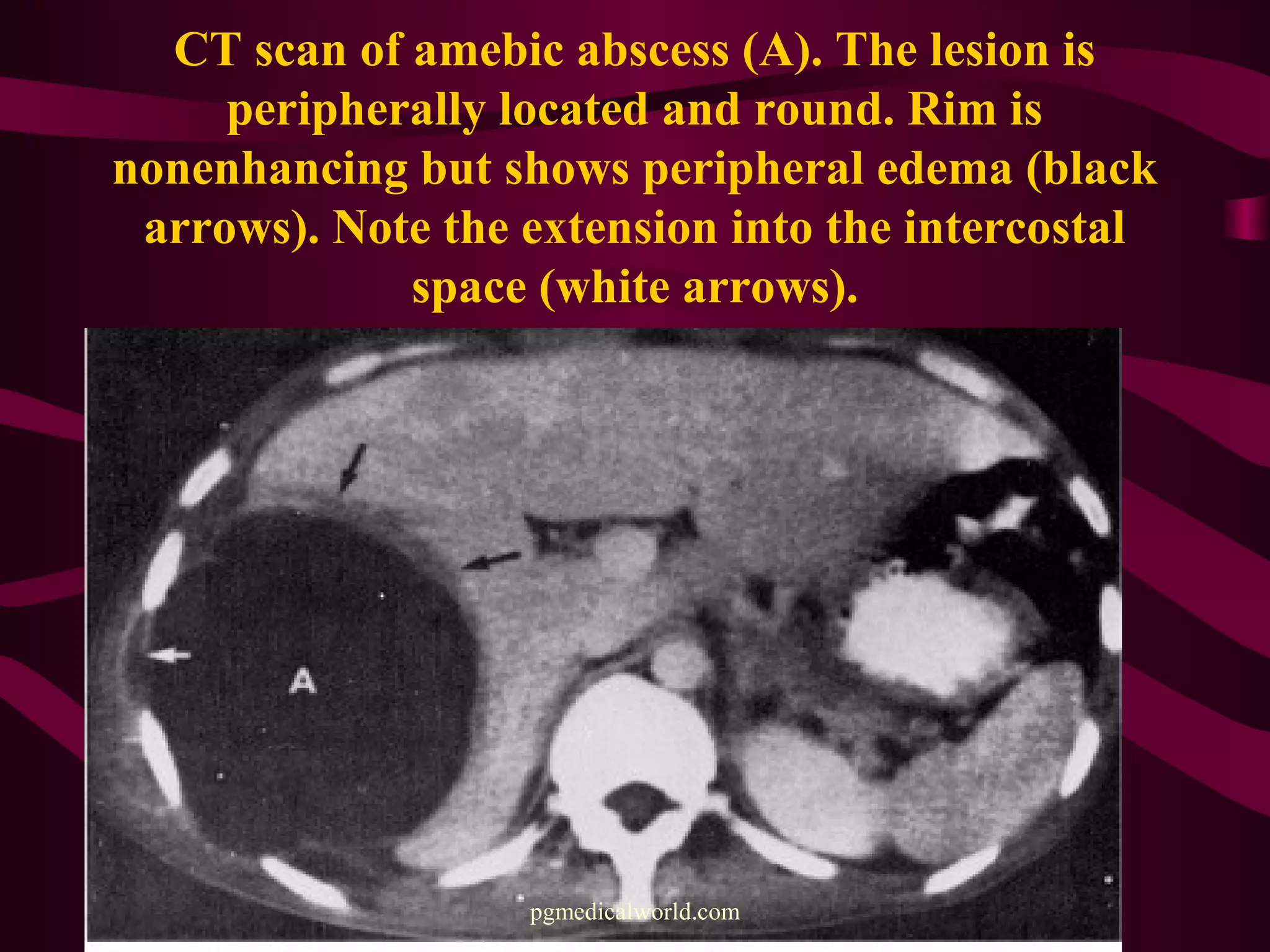 Management of liver abscess | PPT