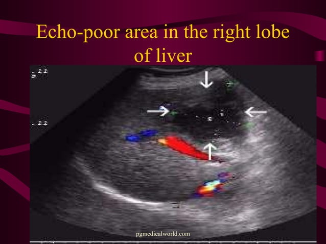 Management of liver abscess | PPT