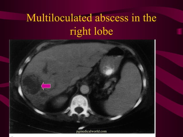 Management of liver abscess | PPT