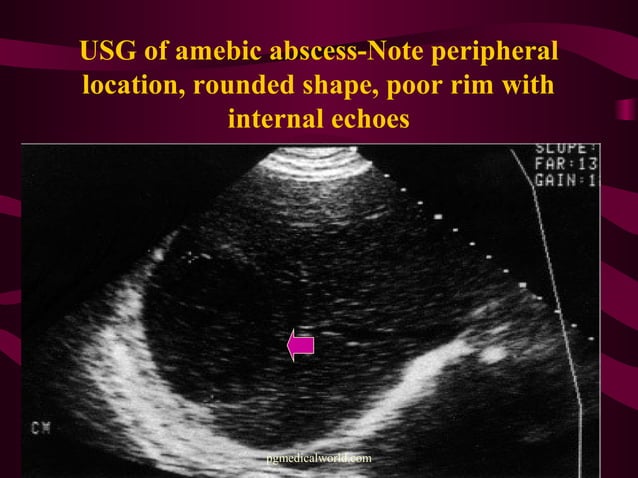 Management of liver abscess | PPT