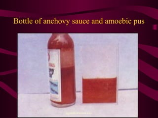 Anchovy Sauce Liver Abscess