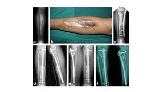 Management of LLD and bone gaps | PPTX