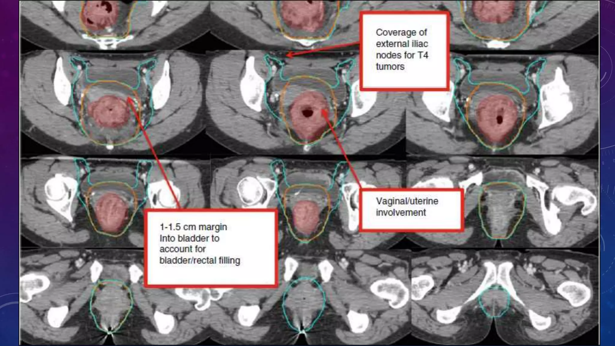 Management of locally advanced rectal cancer | PPTX