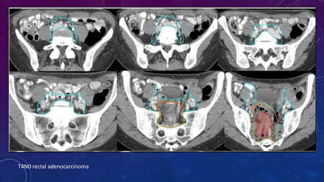 Management of locally advanced rectal cancer | PPTX