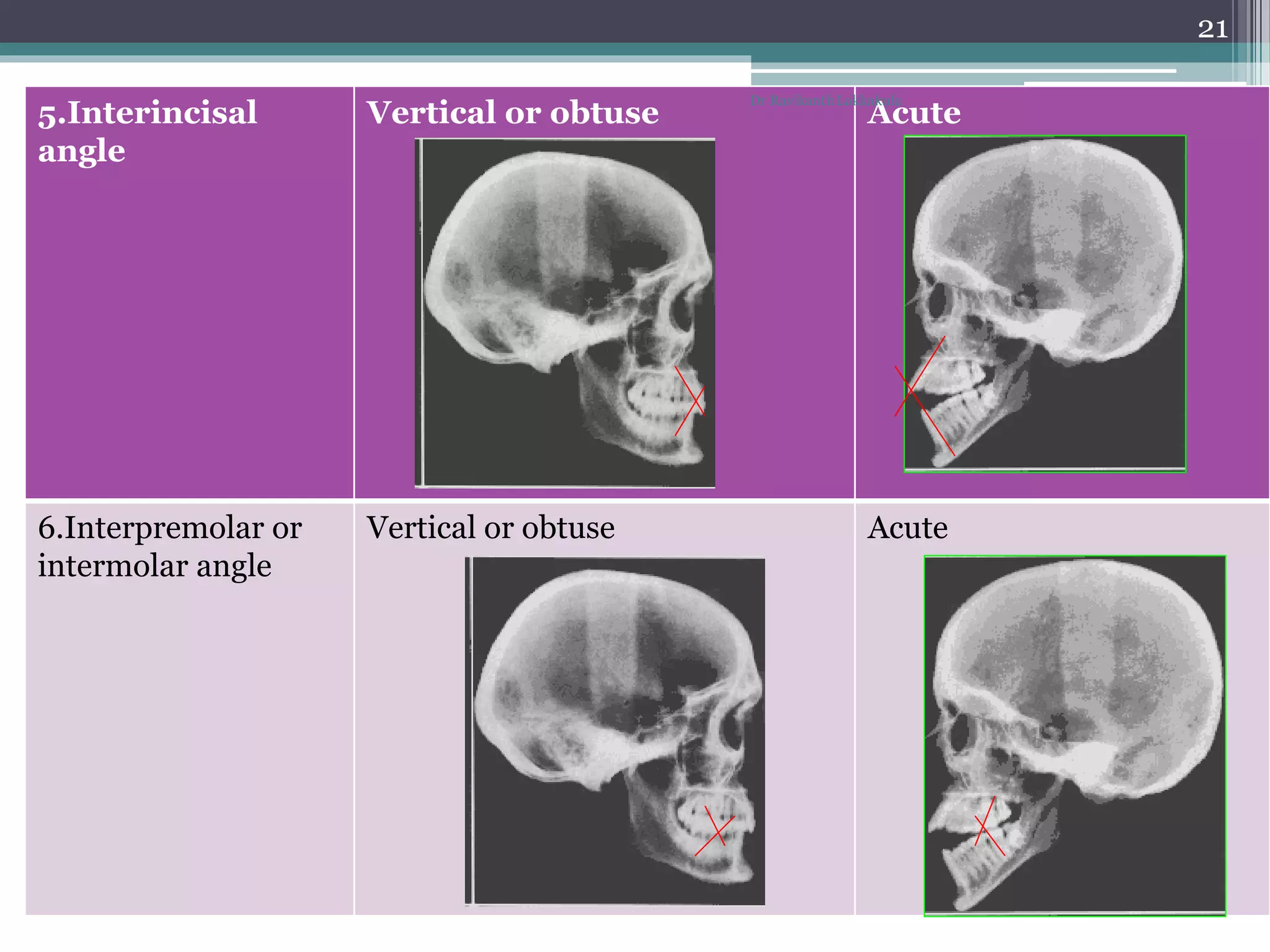 Management of low angle case in orthodontics | PDF