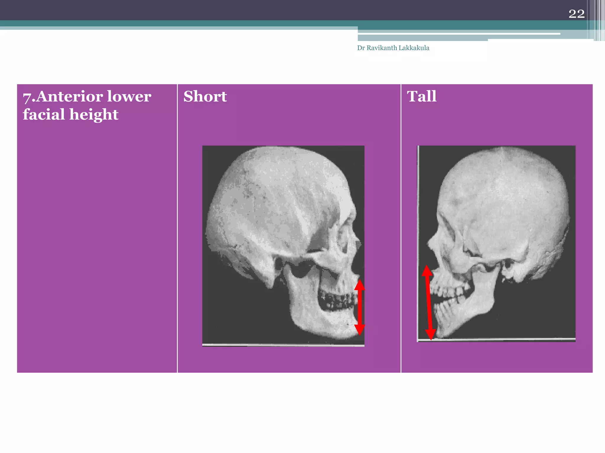 Management of low angle case in orthodontics | PDF