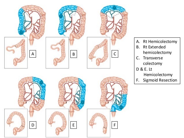 Management of lower Gastrointestinal malignancies