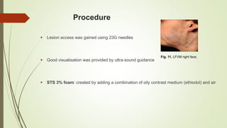 Management of low flow vascularmalformations.pptx