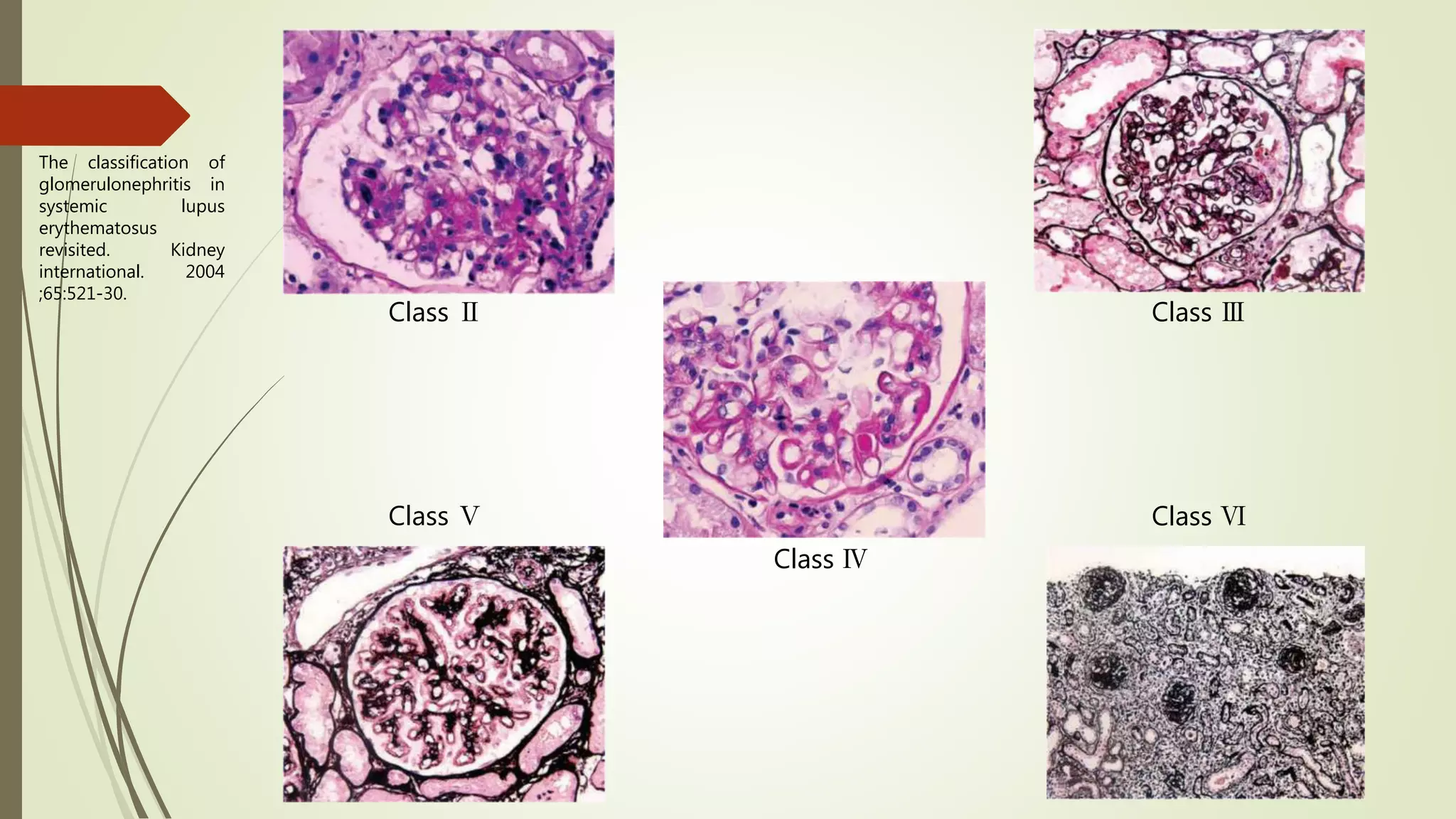Management of lupus nephritis | PPTX