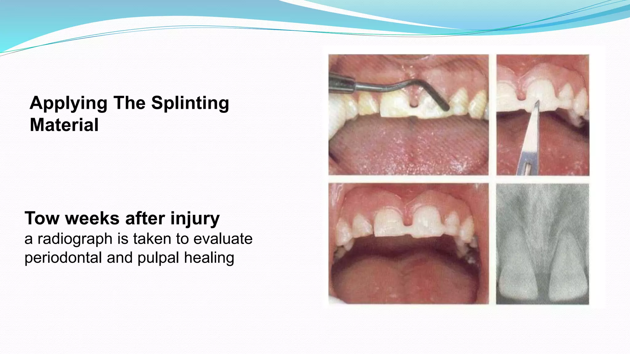Management of luxation injuries | PPTX