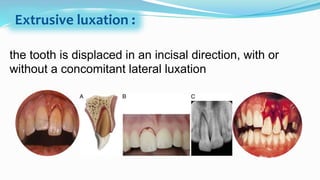 Management of luxation injuries | PPTX