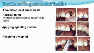 Management of luxation injuries | PPTX | Dental Health | Diseases and ...