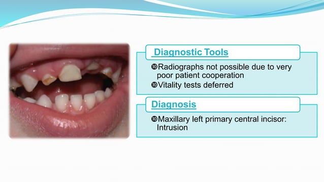 Management of luxation injuries | PPTX | Dental Health | Diseases and ...