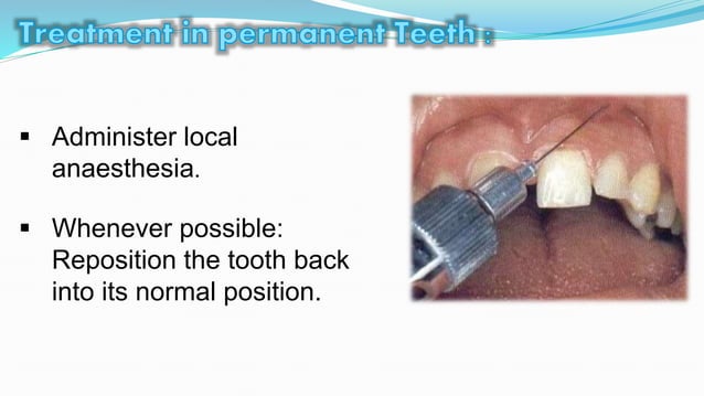 Management of luxation injuries | PPTX | Dental Health | Diseases and ...