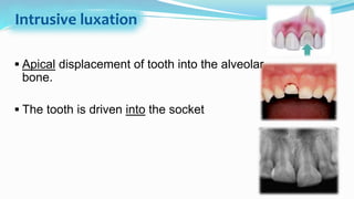 Management of luxation injuries | PPT