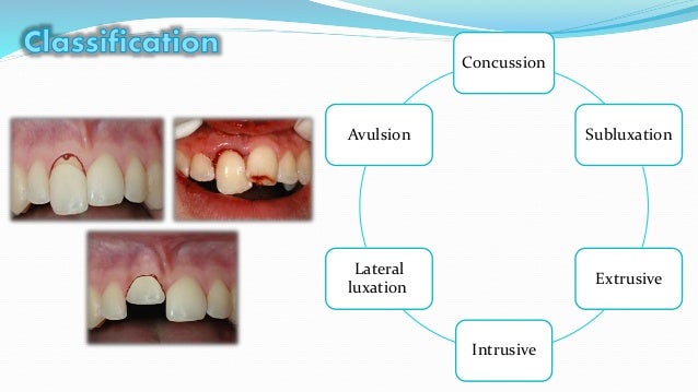 Management of luxation injuries