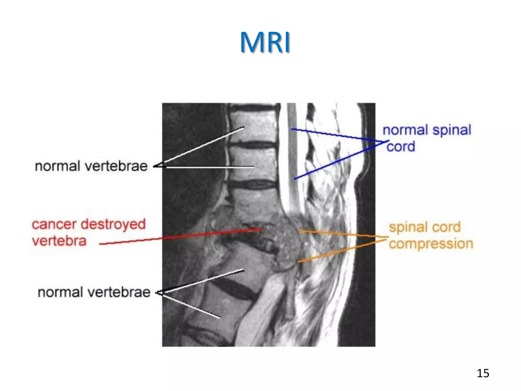 Management of malignant spinal cord compression | PPTX