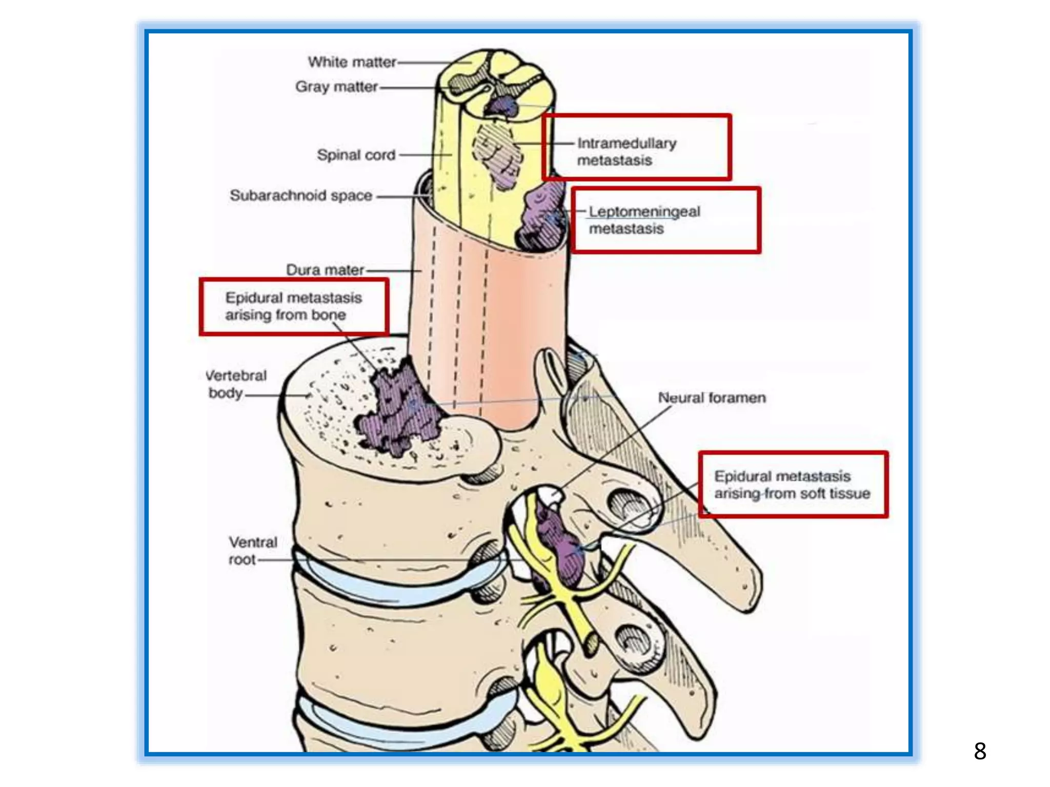 Management of malignant spinal cord compression | PPTX