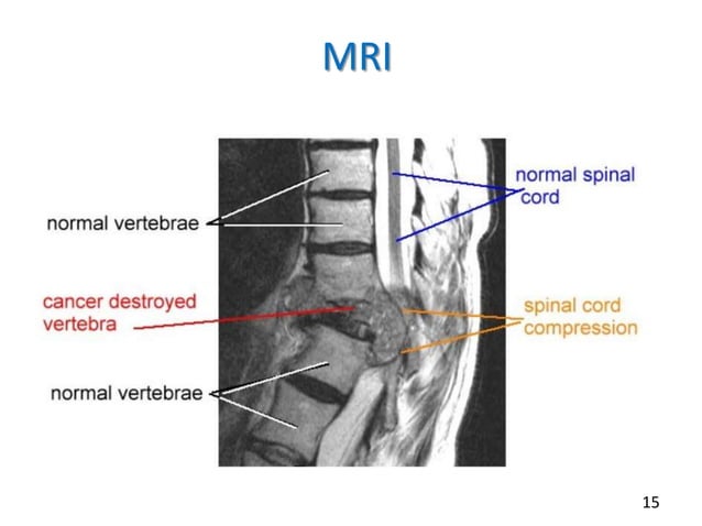 Management of malignant spinal cord compression | PPTX | Cancer ...