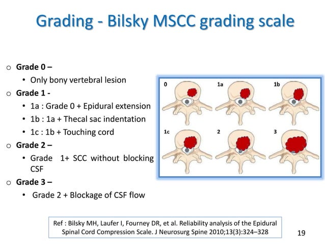 Management of malignant spinal cord compression | PPTX | Cancer ...